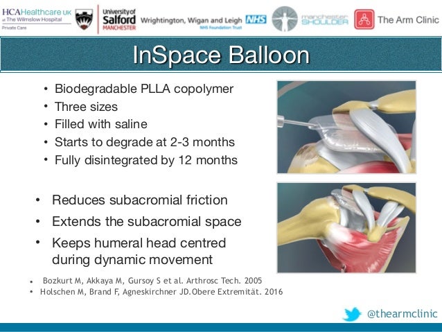 InSpace balloon for massive rotator cuff tears 2017