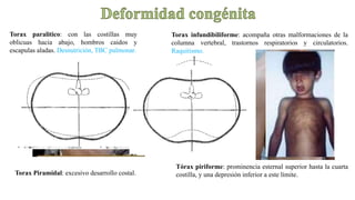 Inspección del Tórax. Semiología caja torácica | PPTX