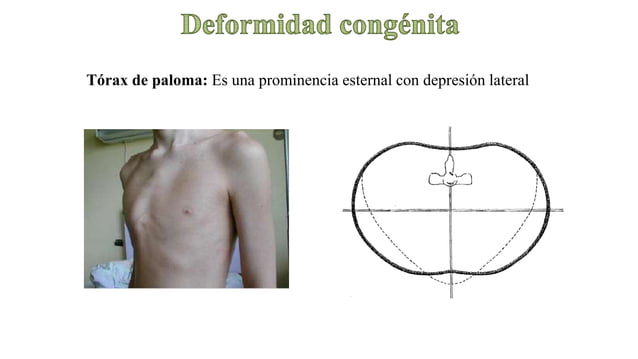 Inspección del Tórax. Semiología caja torácica | PPTX
