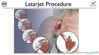 Anterior shoulder Instability in the young athlete 2020 bostaa | PDF