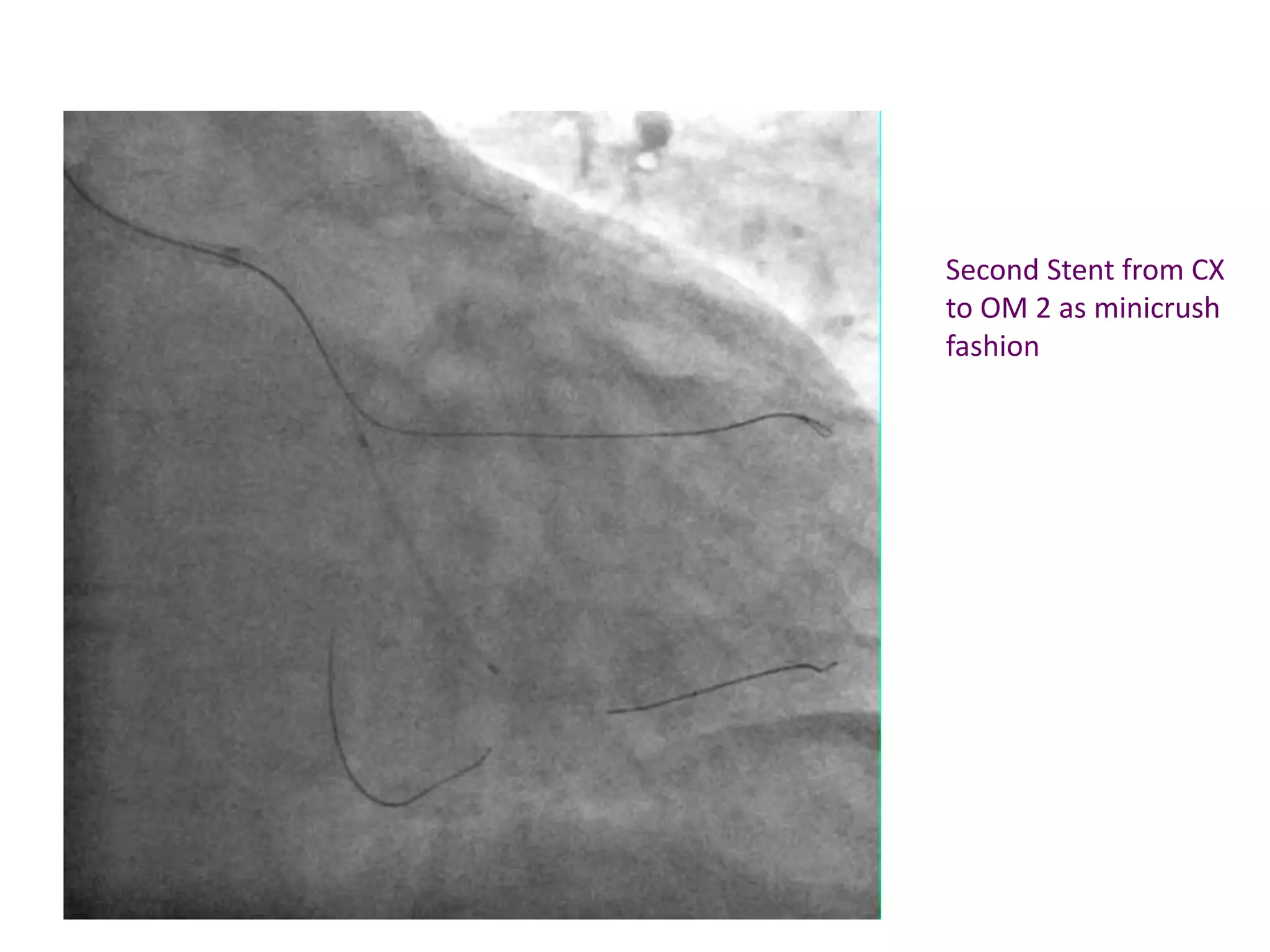 A stent inside the CTO segment | PPTX