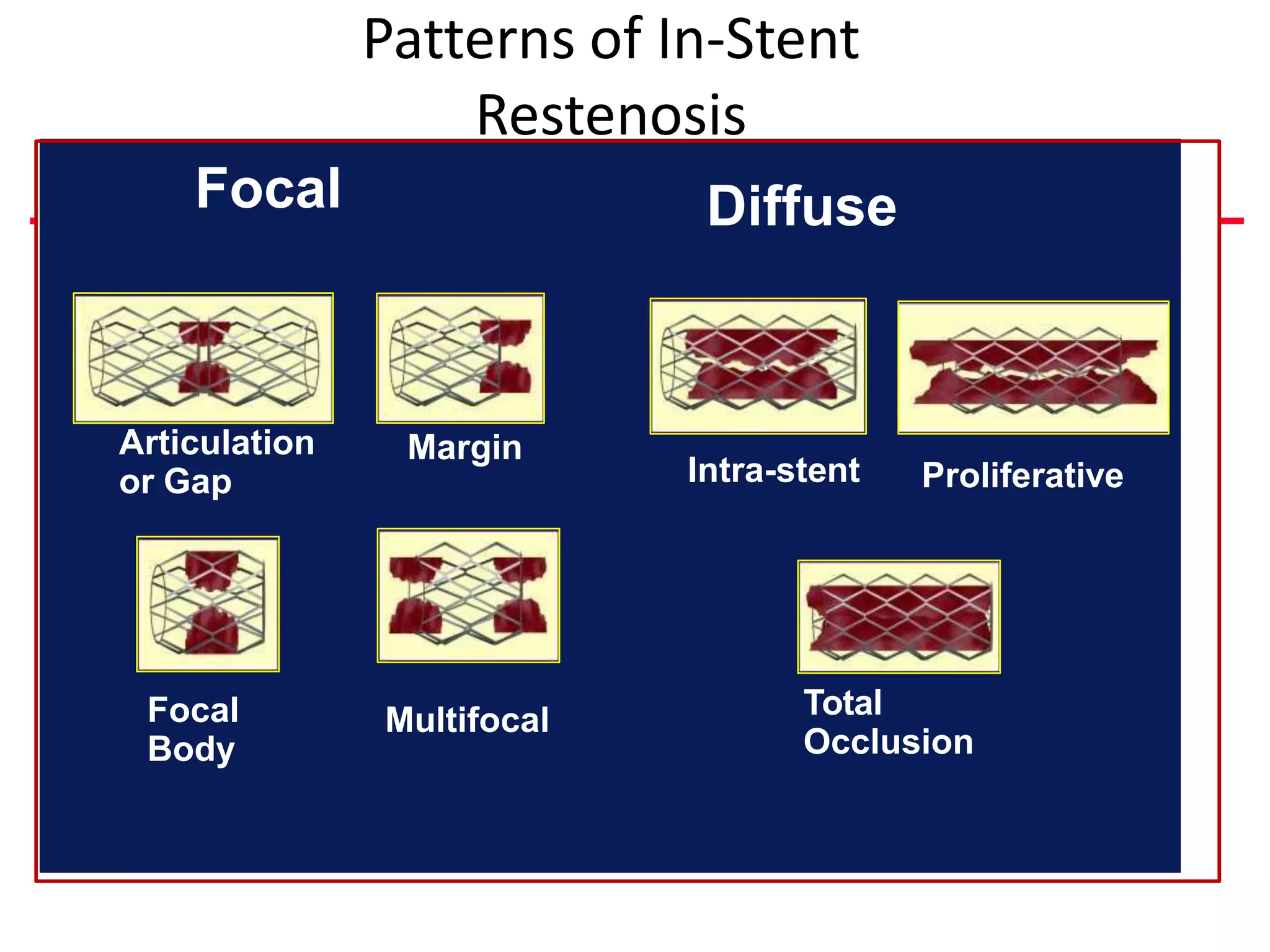 Instent restenosis | PPT