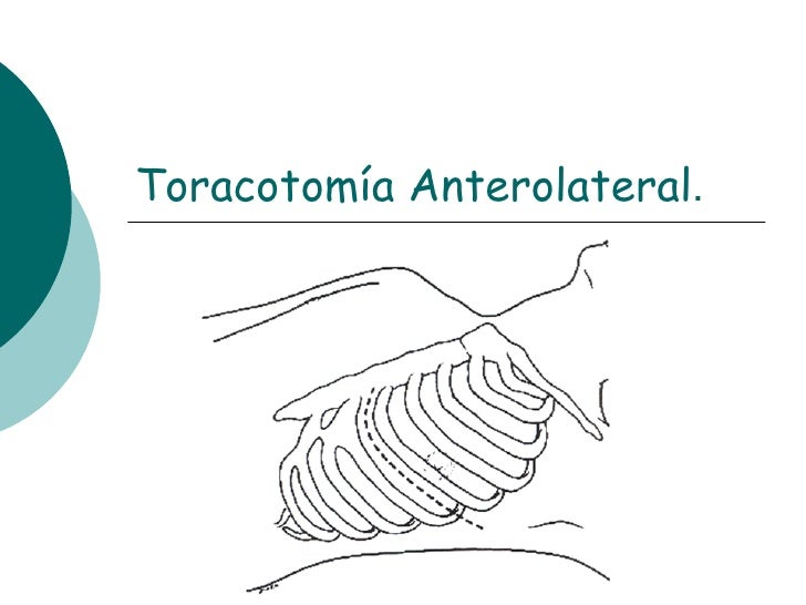 Toracotomia Anterolateral Minimally Invasive Coronary Artery Bypass