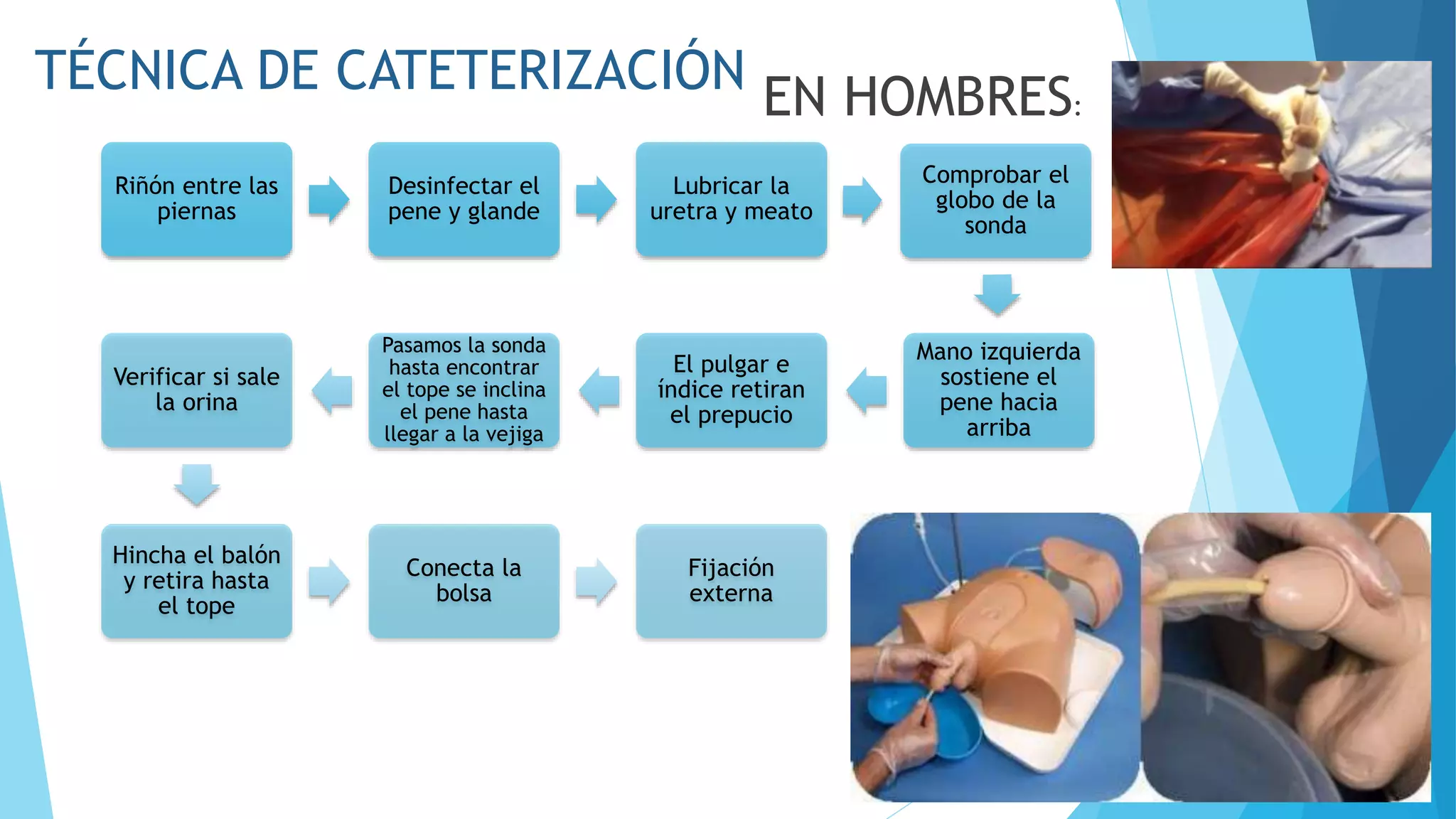 Instrumentación retrógrada de las vías urinarias. Cateterización o ...