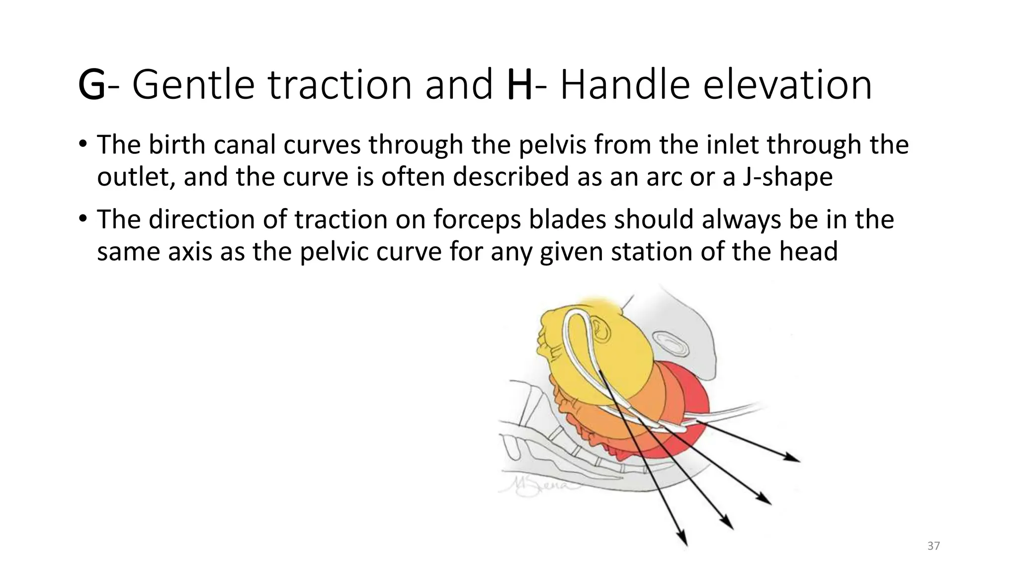 Instrumental delivery - Forceps and Vaccuum | PPTX