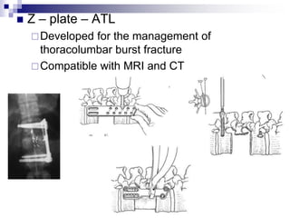 Instrumentation for thoracolumbar fracture_.ppt