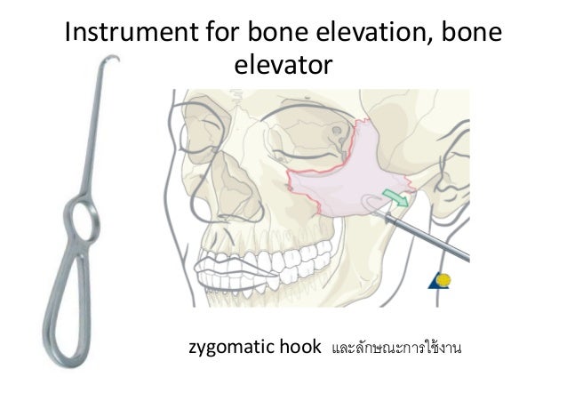 Instrument in oral surgery