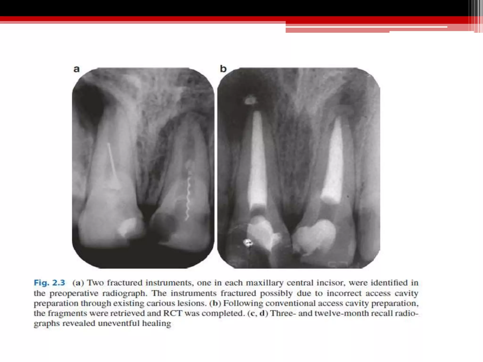 Instrument seperation and its management | PPTX