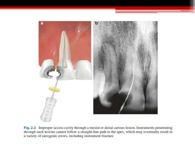 Instrument seperation and its management | PPTX | Dental Health ...