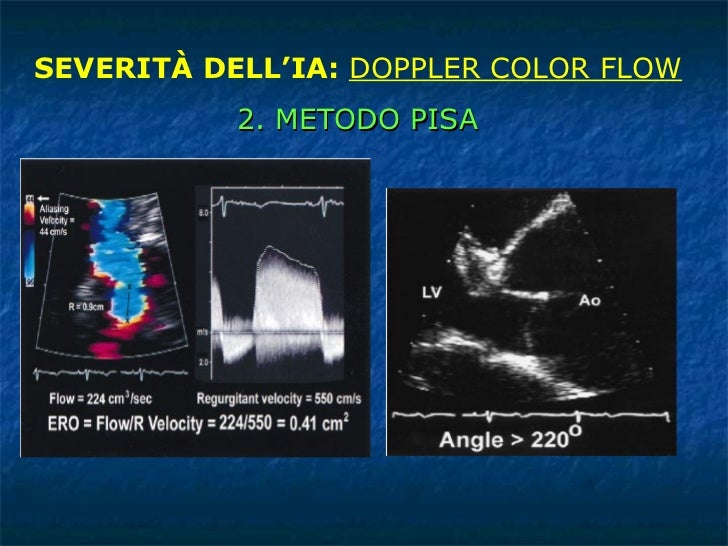 Insufficienza valvolare aortica