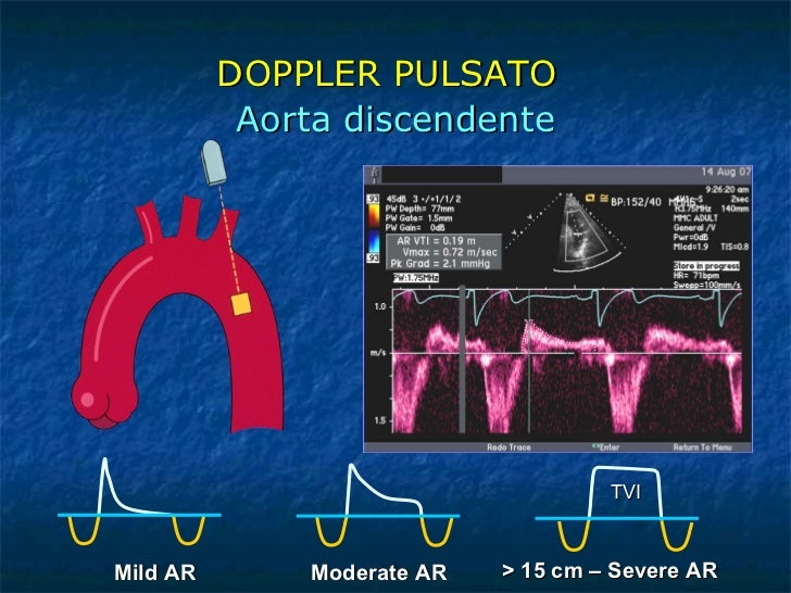 Insufficienza valvolare aortica