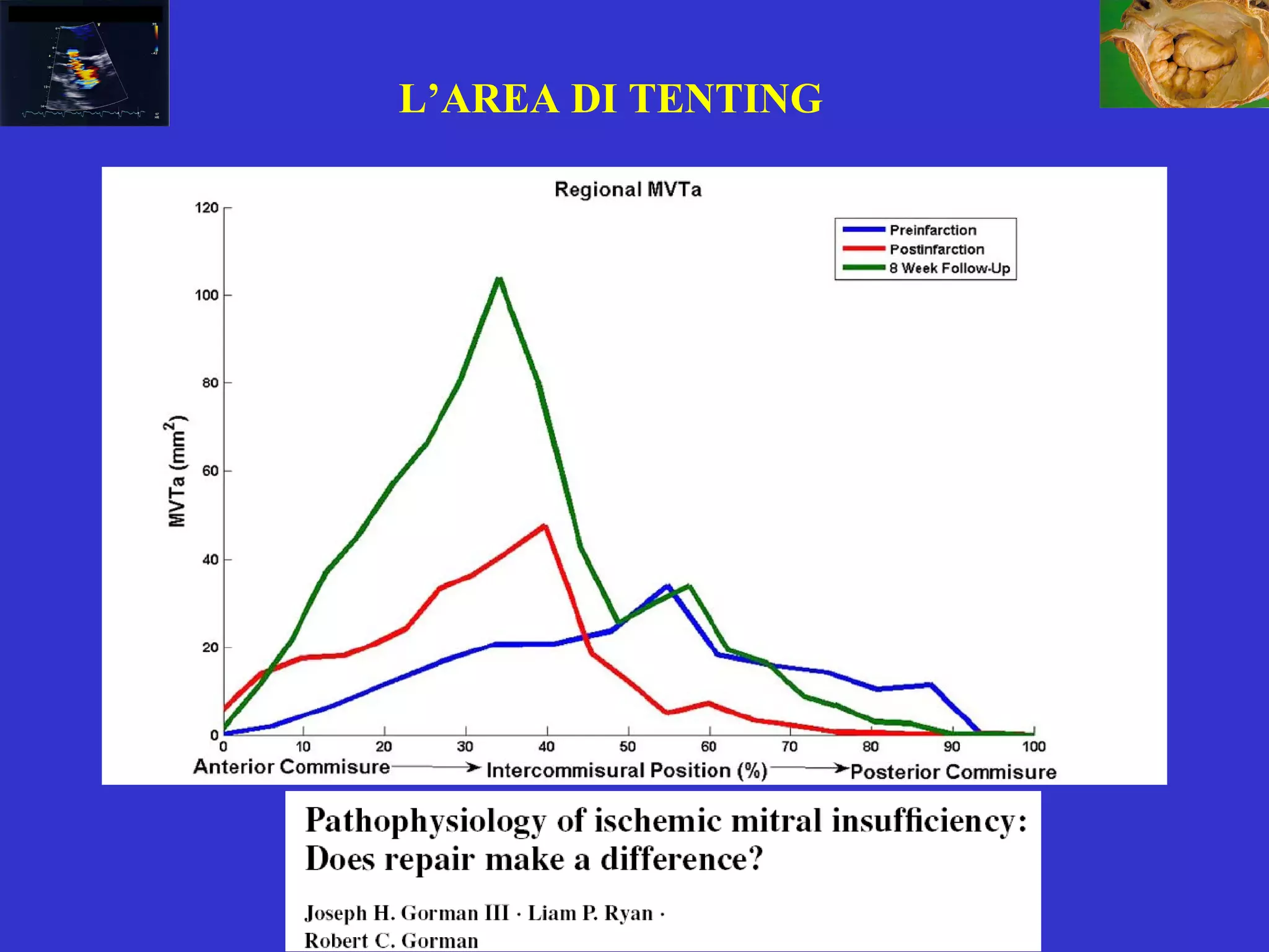 Insufficienza Mitralica Ischemica | PPT | Heart and Cardiovascular ...