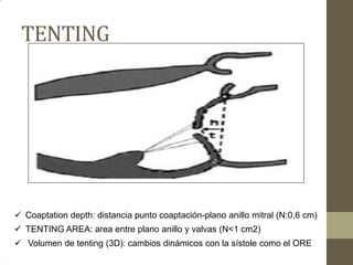 Insuficiencia Mitral Funcional | PDF