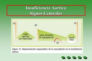 Insuficiencia aortica | PPTX
