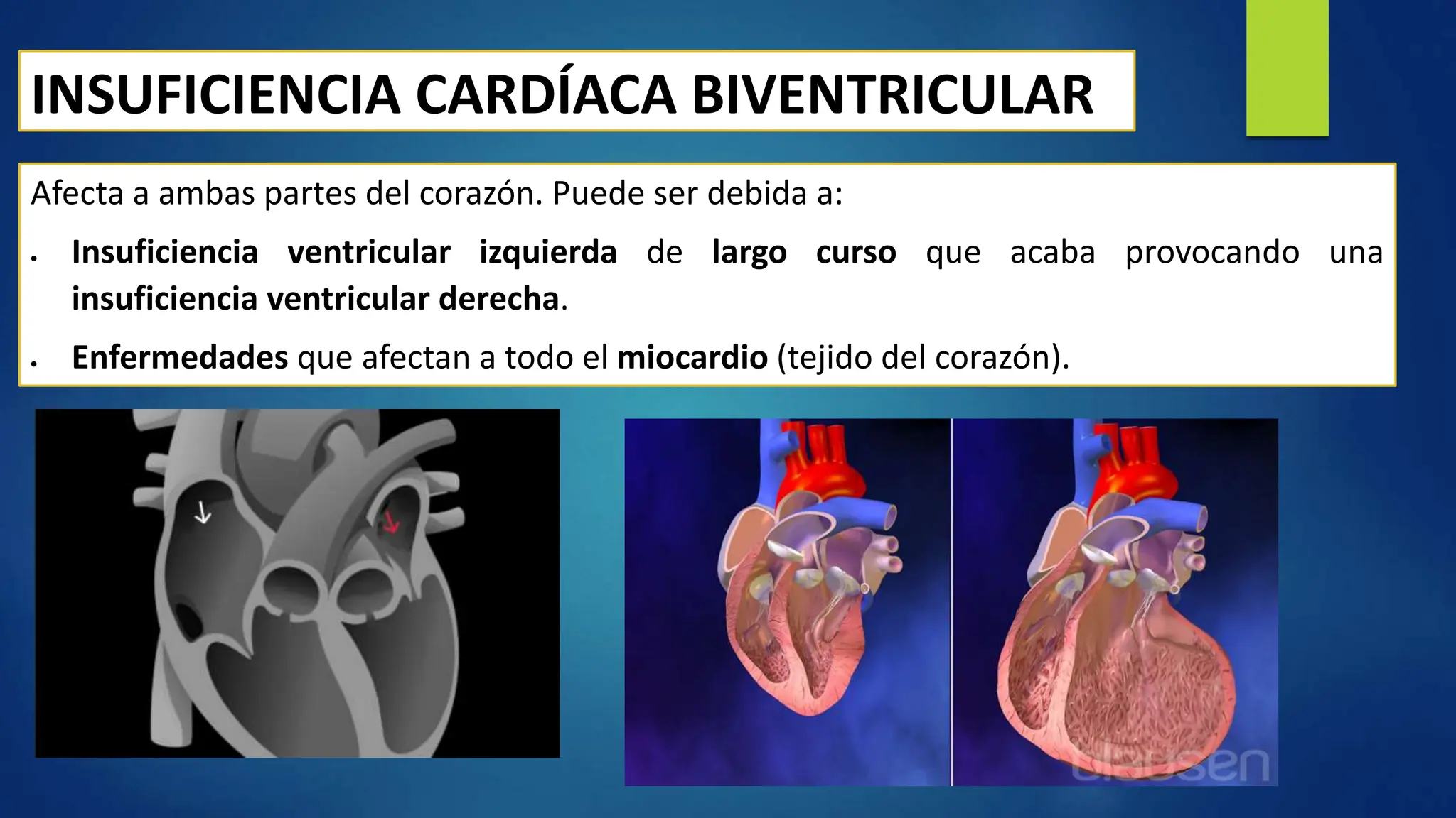 Insuficiencia cardiaca.pptx Más info record | PPT