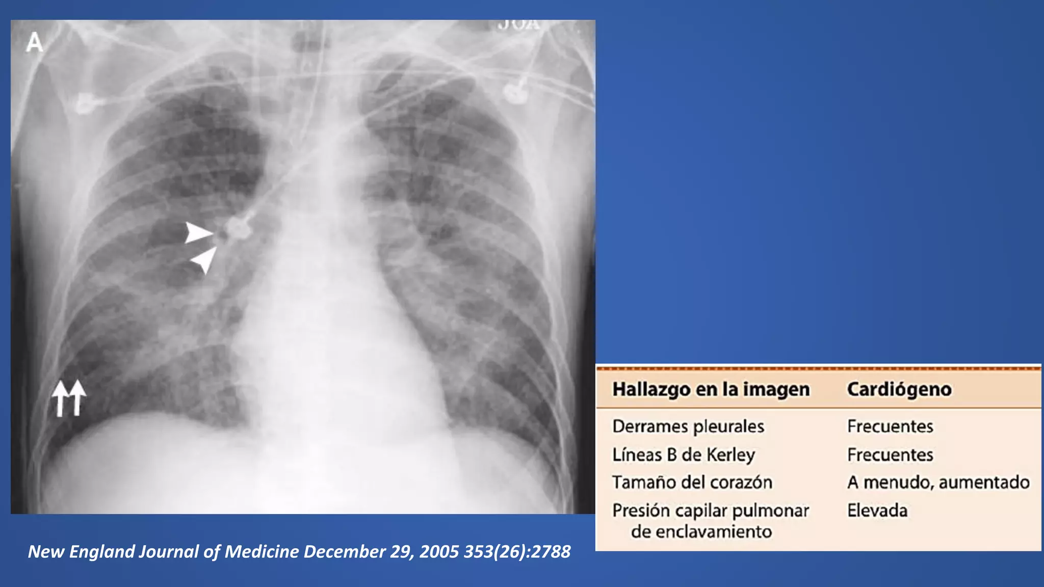 Insuficiencia cardiaca congestiva y edema pulmonar agudo | PPT