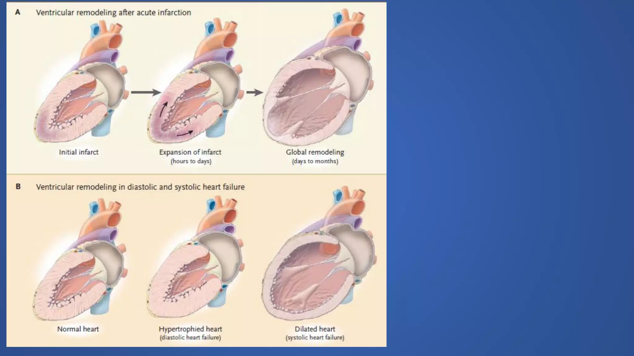 Insuficiencia cardiaca congestiva y edema pulmonar agudo | PPT