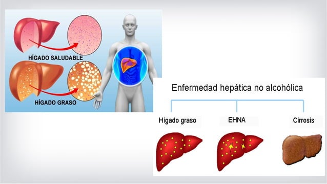 INSUFICIENCIA HEPATICA AGUDA 2024 dinamica | PPTX
