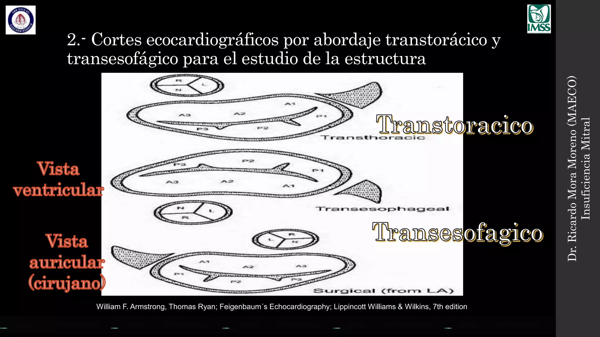 Insuficiencia Mitral y Ecocardiograma | PPTX