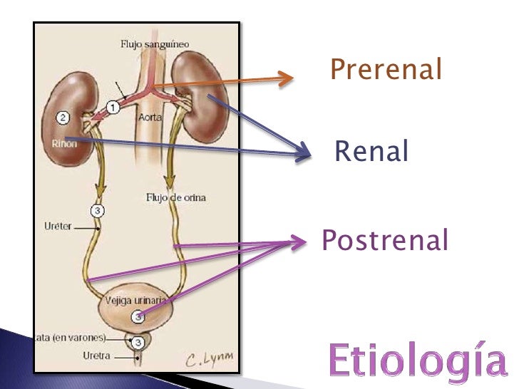 Insuficiencia renal aguda