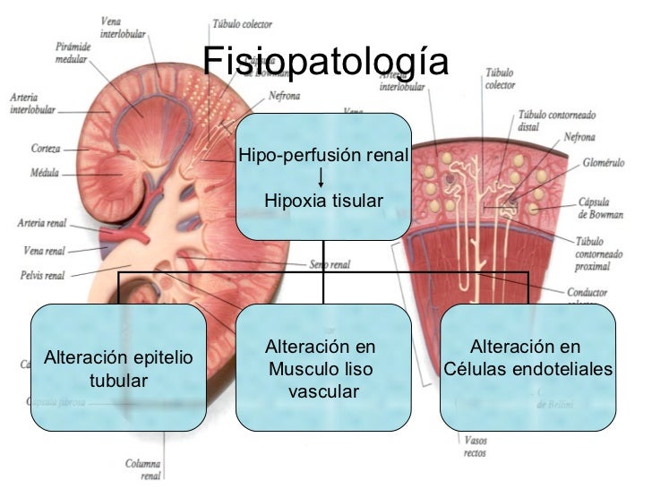 Insuficiencia Renal Aguda