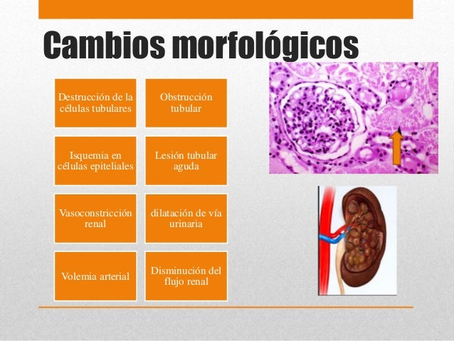Insuficiencia renal y necrosis tubular aguda