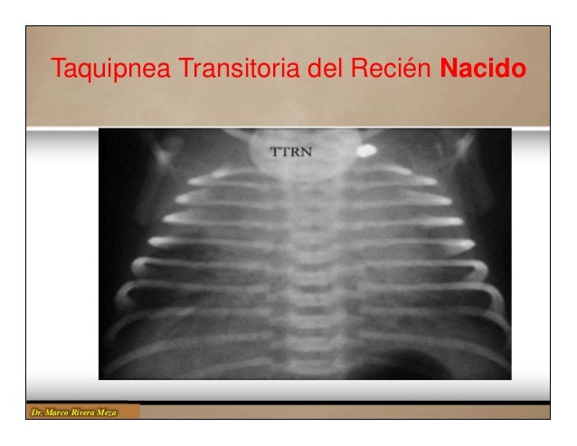 Insuficiencia respiratoria en el Recién Nacido