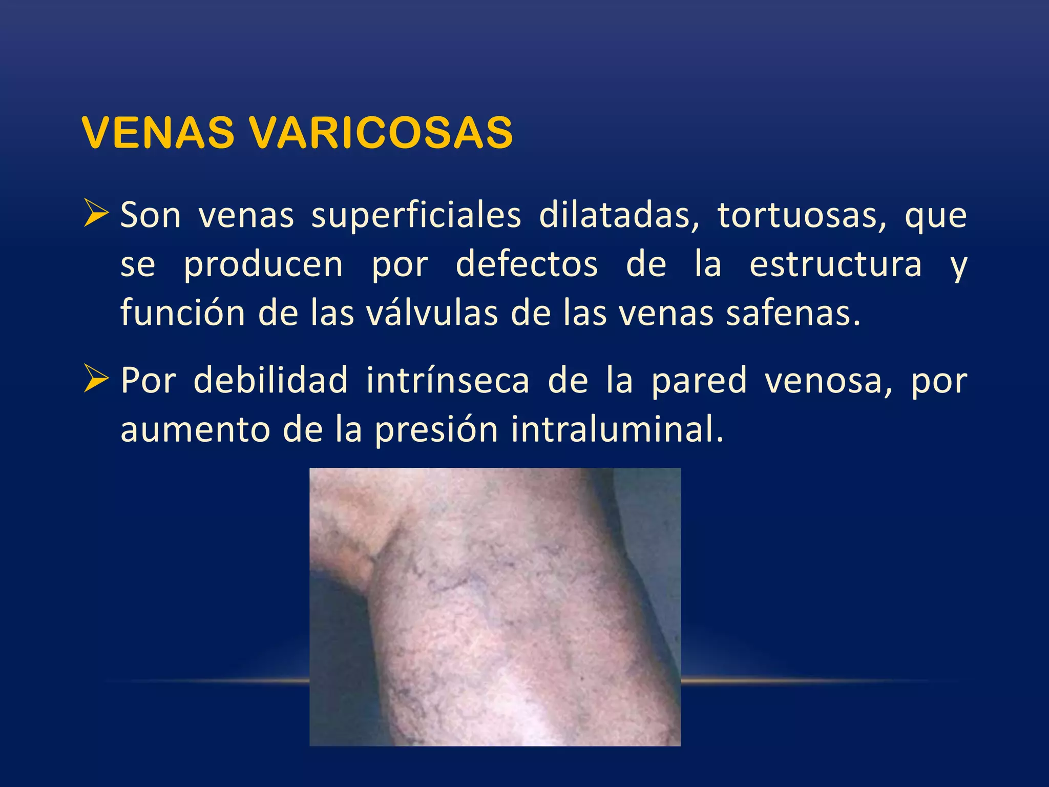 Insuficiencia venosa | PPTX