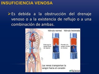 Insuficiencia venosa | PPTX