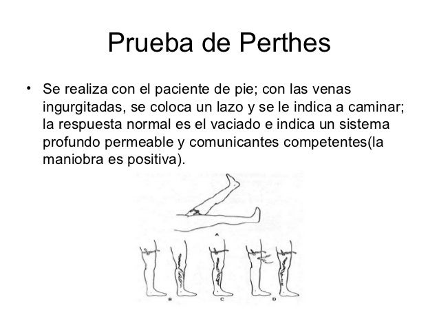 Insuficiencia venosa