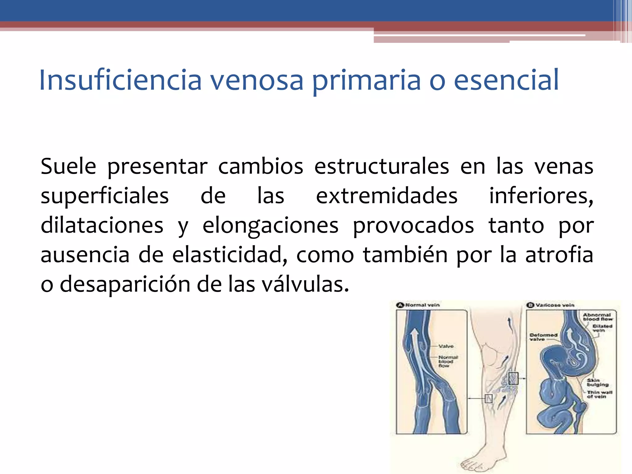 Insuficiencia venosa | PPTX