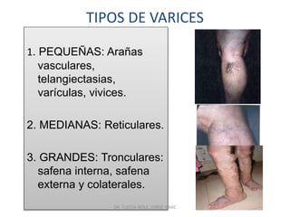 Insuficiencia venosa | PPTX