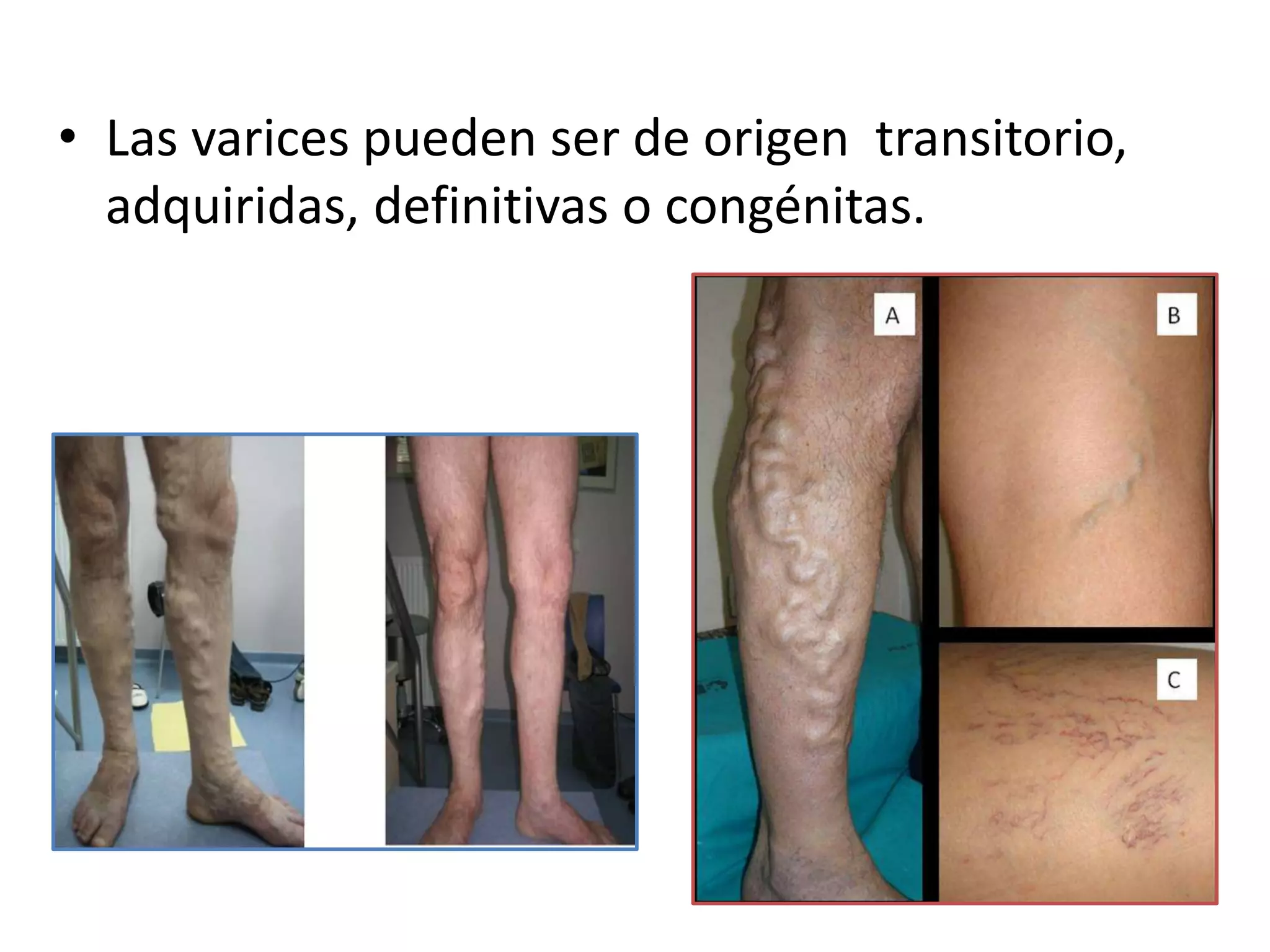 Insuficiencia venosa | PPTX