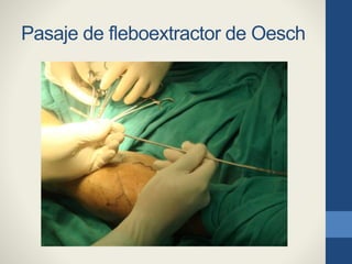 Insuficiencia venosa Oswaldo Silva Rodríguez Cirujano Cardiovascular ...