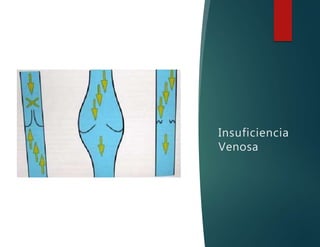 Insuficiencia venosa | PPTX
