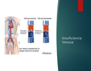 Insuficiencia venosa | PPTX