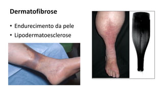 Insuficiência Venosa Crônica | PPT