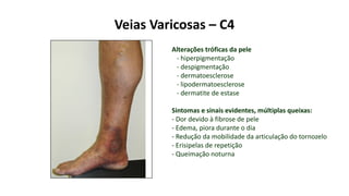 Insuficiência Venosa Crônica | PPT