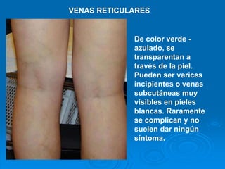 INSUFICIENCIA VENOSA | PPTX