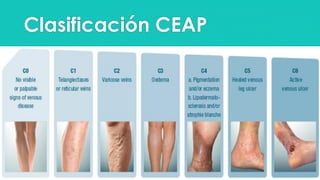 Insuficiencia venosa cronica | PPT