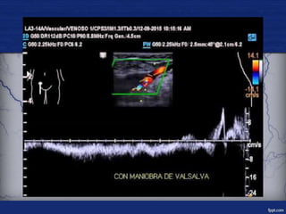 La Ecografía Doppler En La Insuficiencia Venosa Pptx