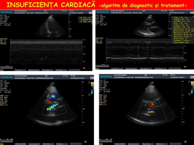 Insuficienta cardiaca | PPTX