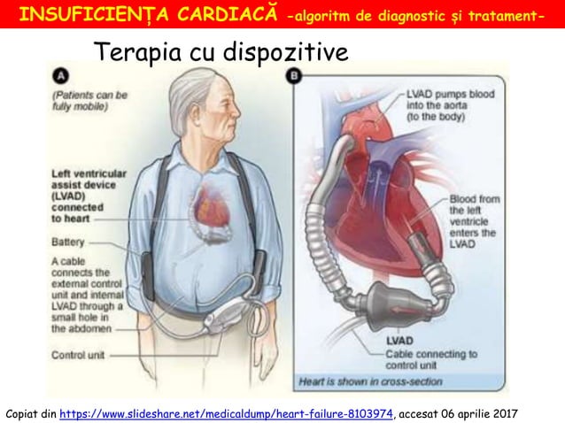 Insuficienta cardiaca | PPTX