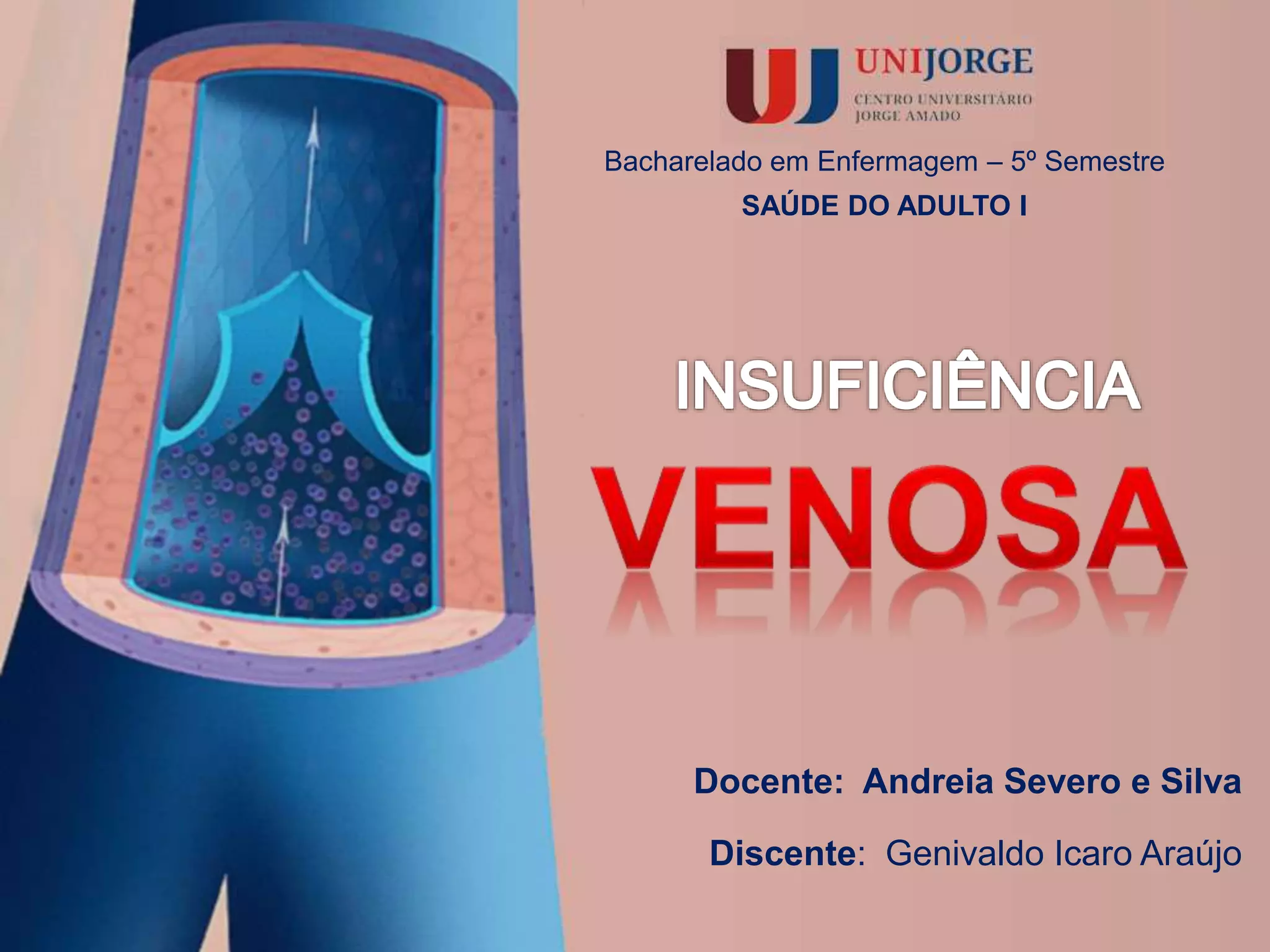 Insuficiência Venosa - Saúde do Adulto | PPTX