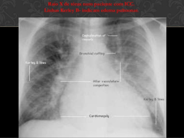 Insuficiência cardíaca congestiva da câmara esquerda