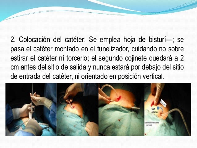 Insuficiencia renal crónica (IRC), Diálisis, cateter tenckhoff