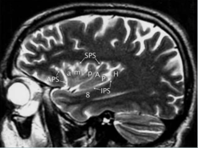 Insular lobe anatomy | PPTX | Brain and Nervous System Disorders ...