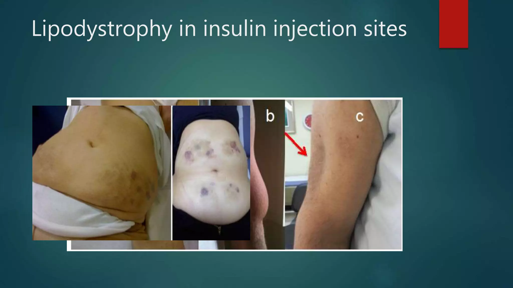 Insulin.pptx