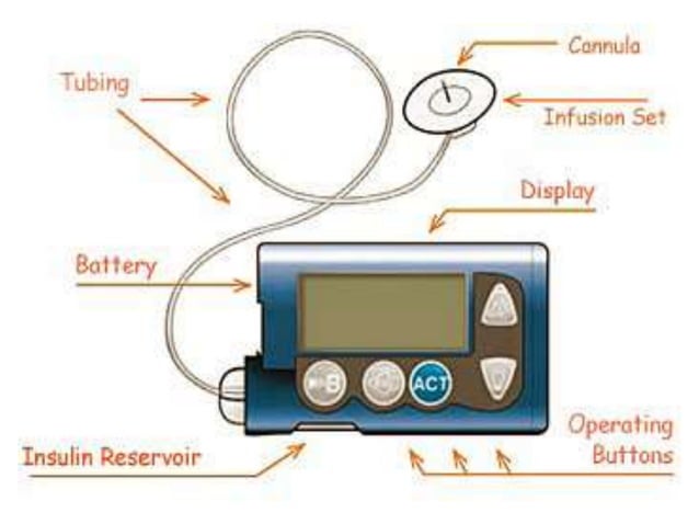 Insulin pumps | PPT