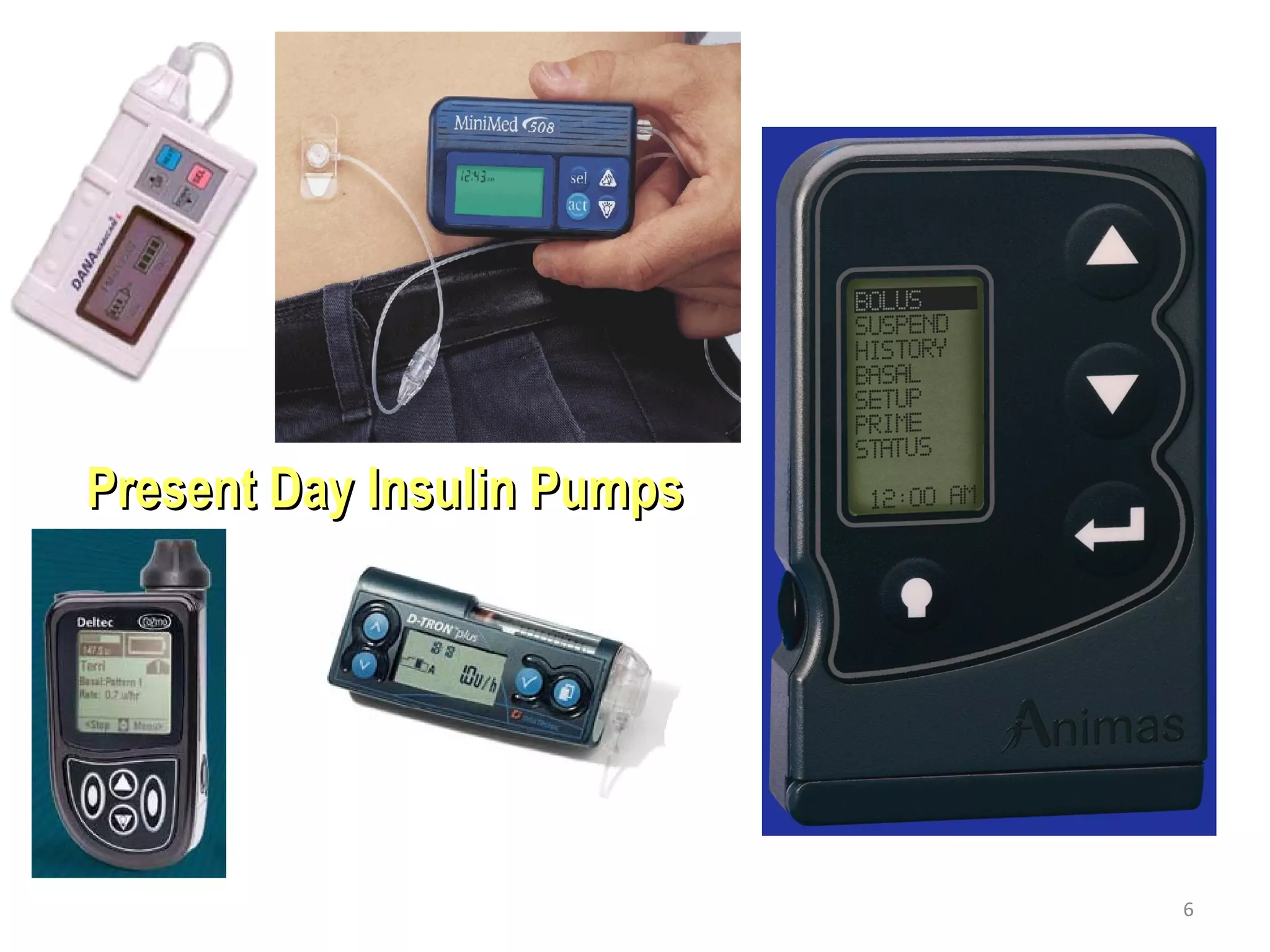 Insulin Pump | PPT
